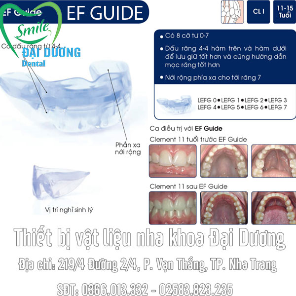 EF Guide (Hạng I, đang thay R nanh và R cối nhỏ, 11-15 tuổi, 8 size ...